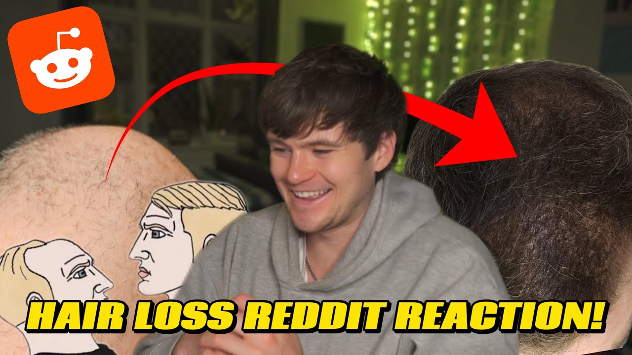 Reacting to HAIR LOSS REDDIT! (Tressless) - YouTube