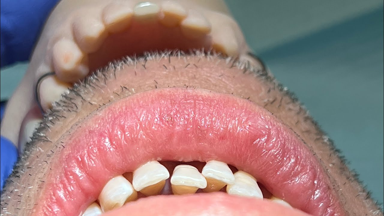 Simple Extraction, Particulate Bone Graft, Osseous Plug, No Suture, and ...