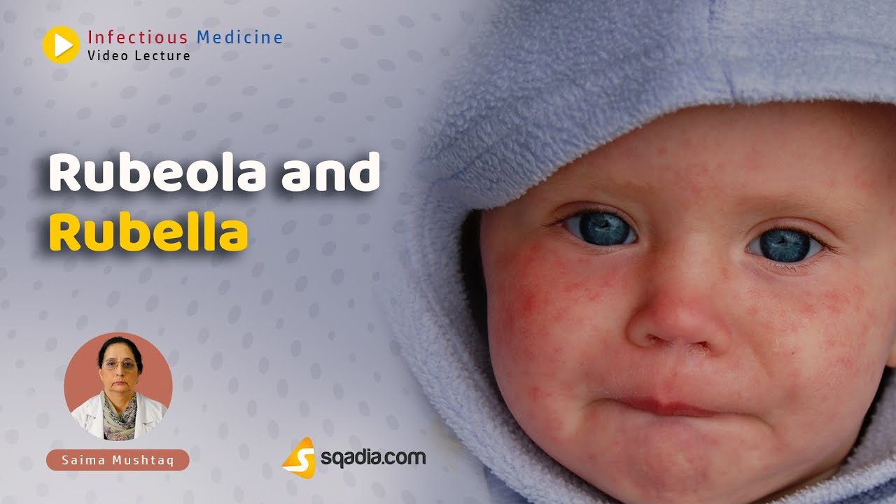 Rubeola and Rubella | Introduction | Infectious Medicine | sqadia.com ...