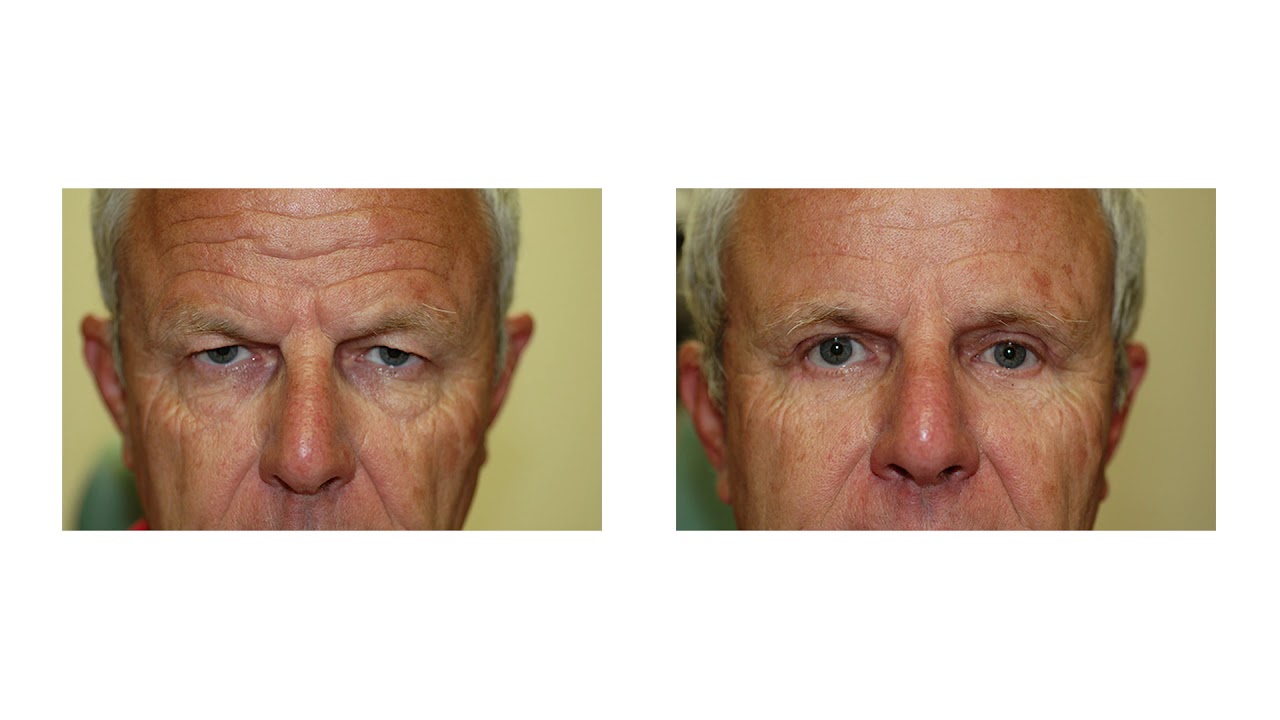 Looking tired or angry? Things you need to know about Forehead Lift ...
