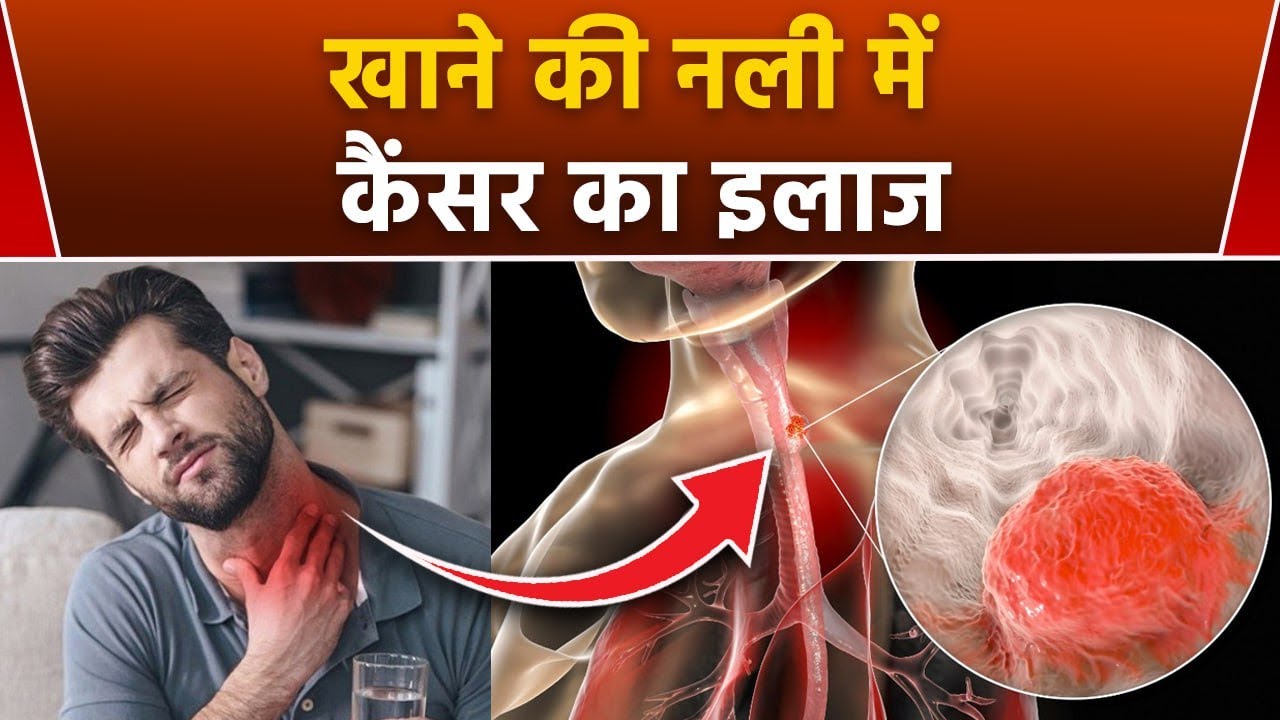 Esophageal Cancer Treatment: Food Pipe Cancer Treatment In Hindi ...