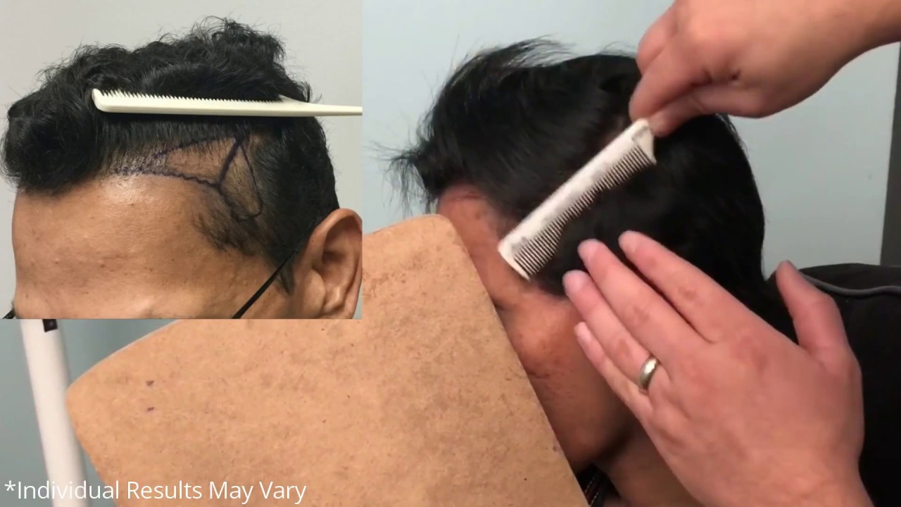 Dense packing Hair Transplant Results in Los Angeles - Hair Restoration ...