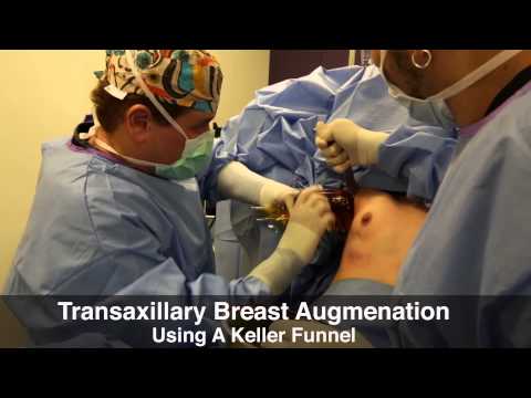 Breast Augmentation Surgery by Hawaii Plastic Surgeon (Graphic ...