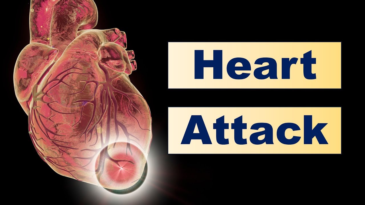 Heart Attack I Causes, Symptoms, Prevention and Treatments - YouTube