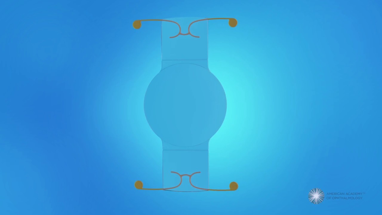 What is an accommodative intraocular lens (IOL)? - YouTube