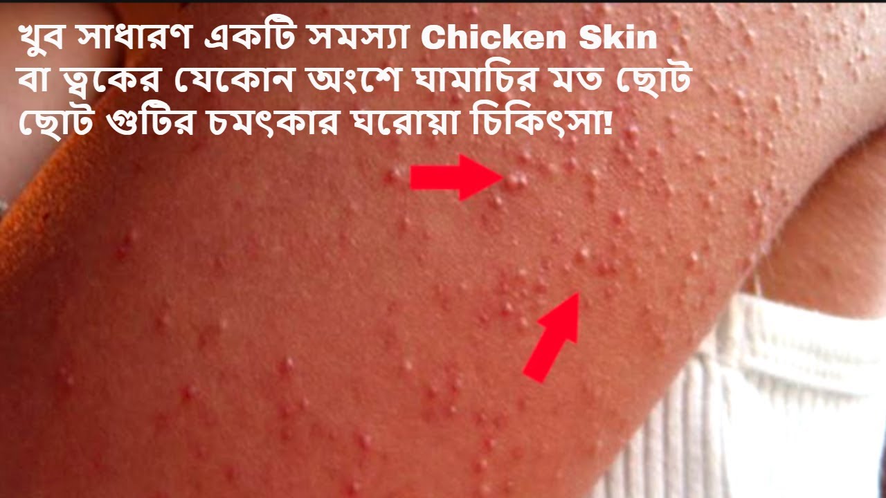 Chicken Skin বা ত্বকে ঘামাচির মত ছোট ছোট গুটির ঘরোয়া চিকিৎসা! - YouTube
