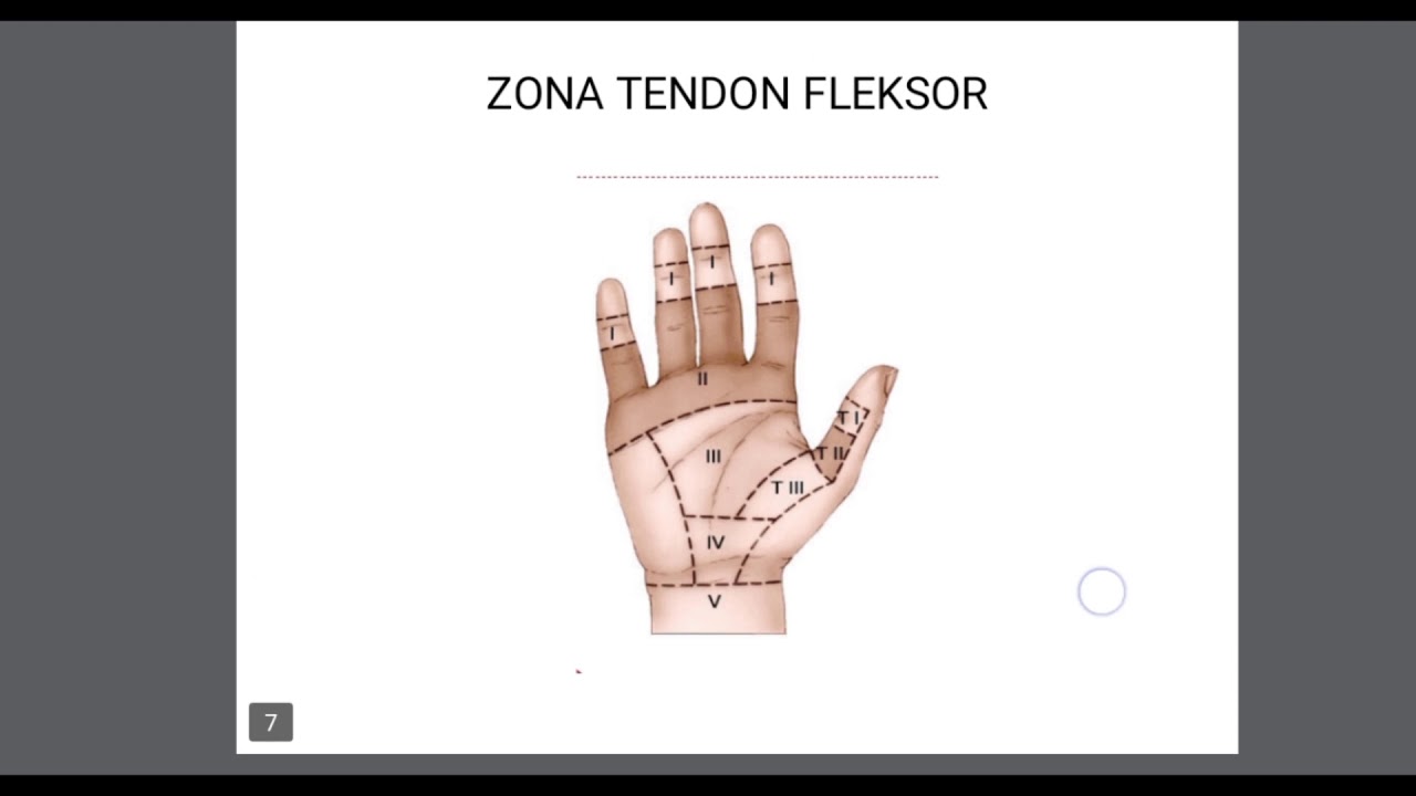 Aplikasi Splint dan Alat Bantu pada kondisi Cedera Tendon Fleksor - YouTube