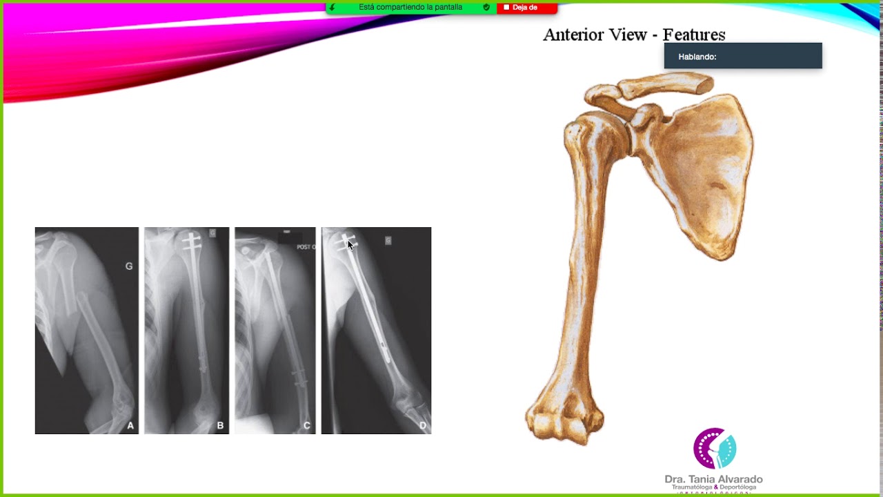 VIDEO CLASE FX DIAFISIS HUMERO - YouTube