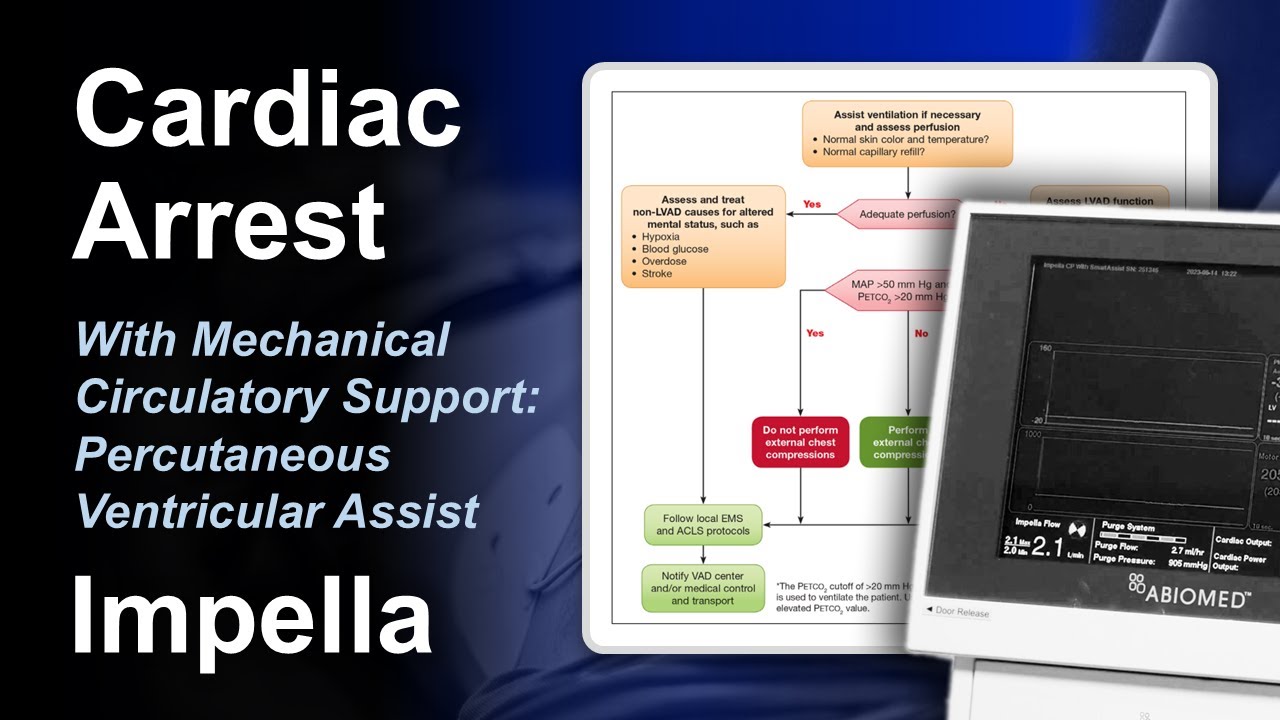 Cardiac Arrest with an Impella - YouTube
