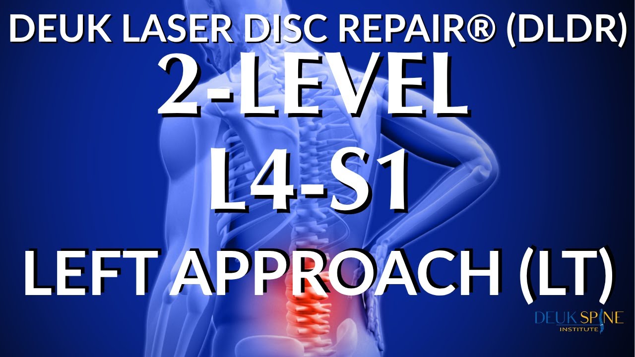 LOWER BACK HERNIATIONS L4-L5, L5-S1 - LIVE - Laser Spine Surgery - YouTube