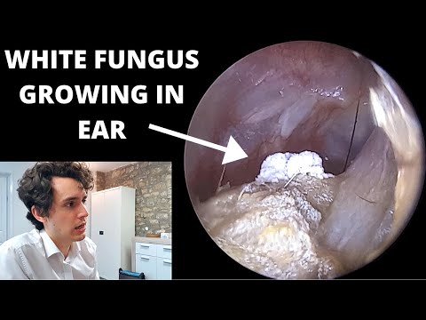 How To Know If You Have A Fungal Ear Infection