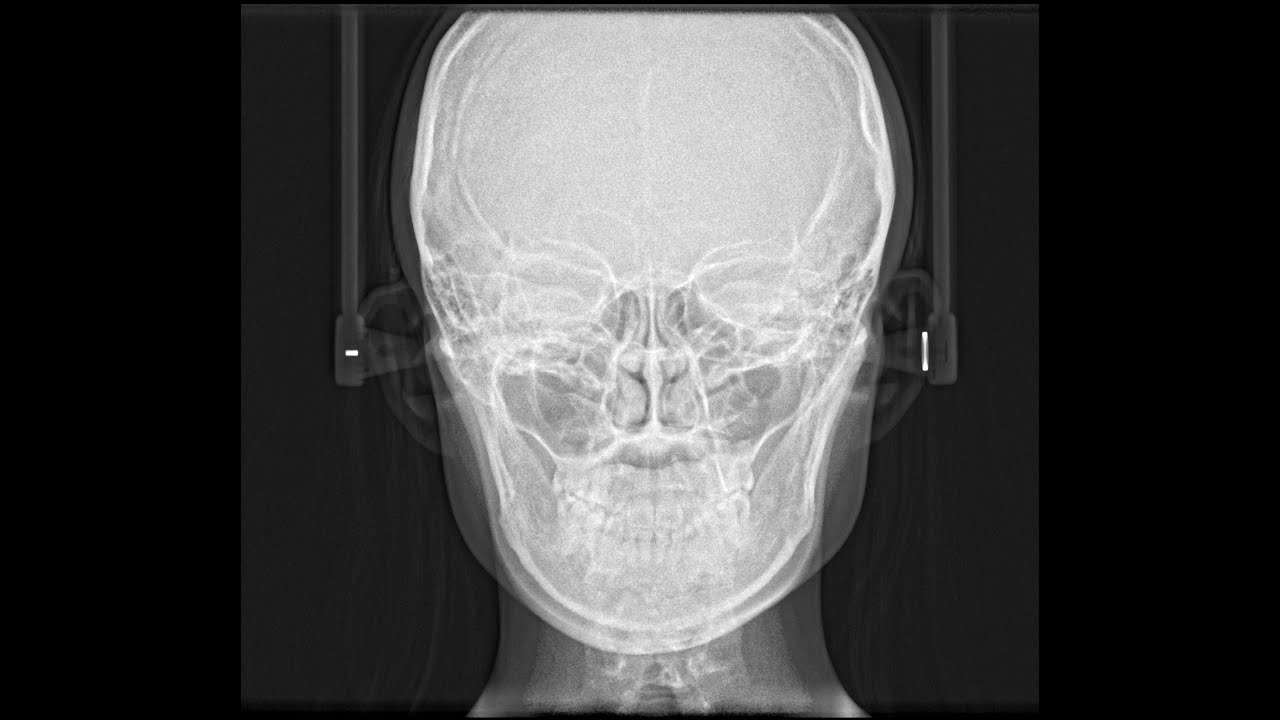 PreXion3D CBCT EXPEDITION - Cephalometric PA (Posteroanterior) Scan ...