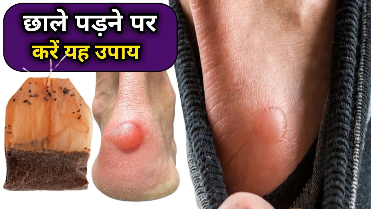 pair ke chhale kaise thik kare | hath ke chhale kaise thik kare - YouTube