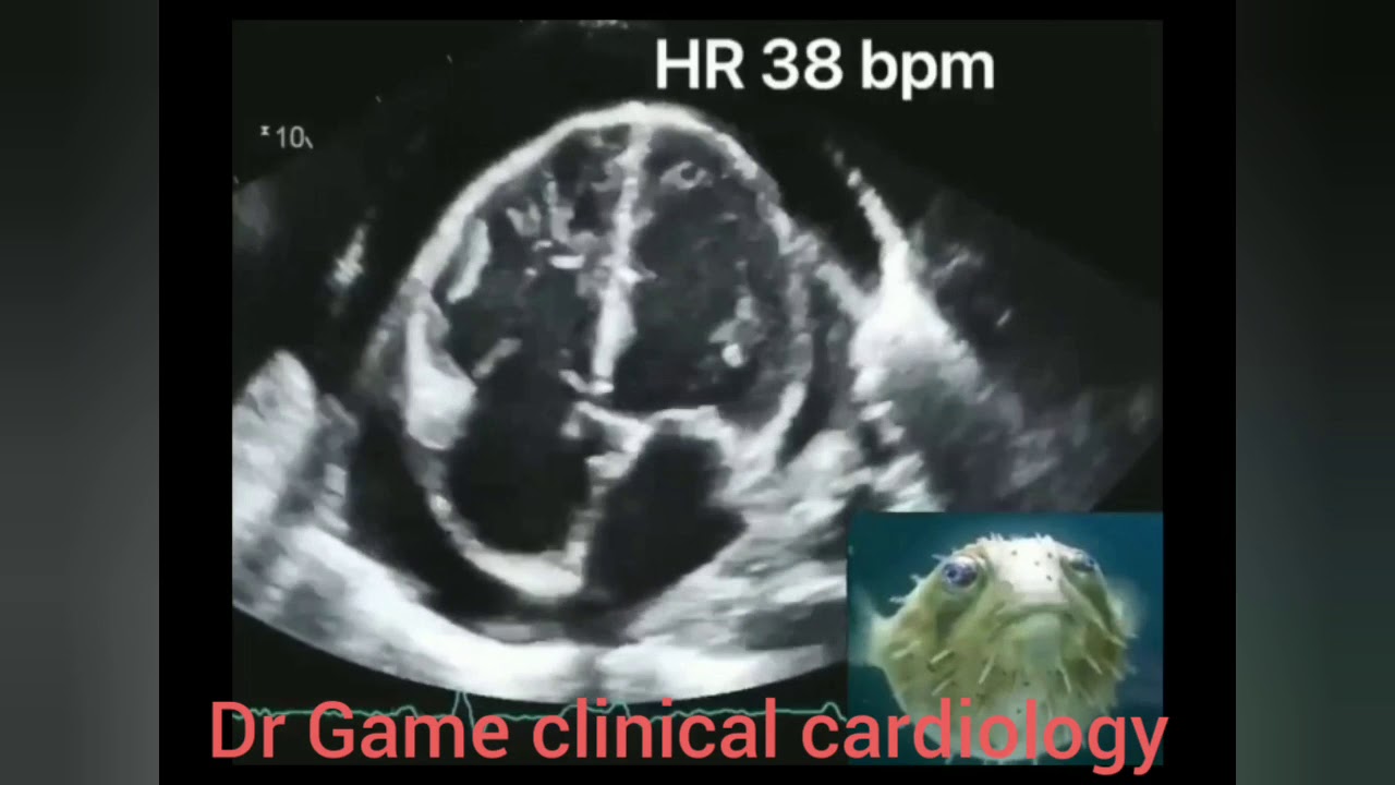Pericardial Effusion - echo clip - The Echo Channel - YouTube