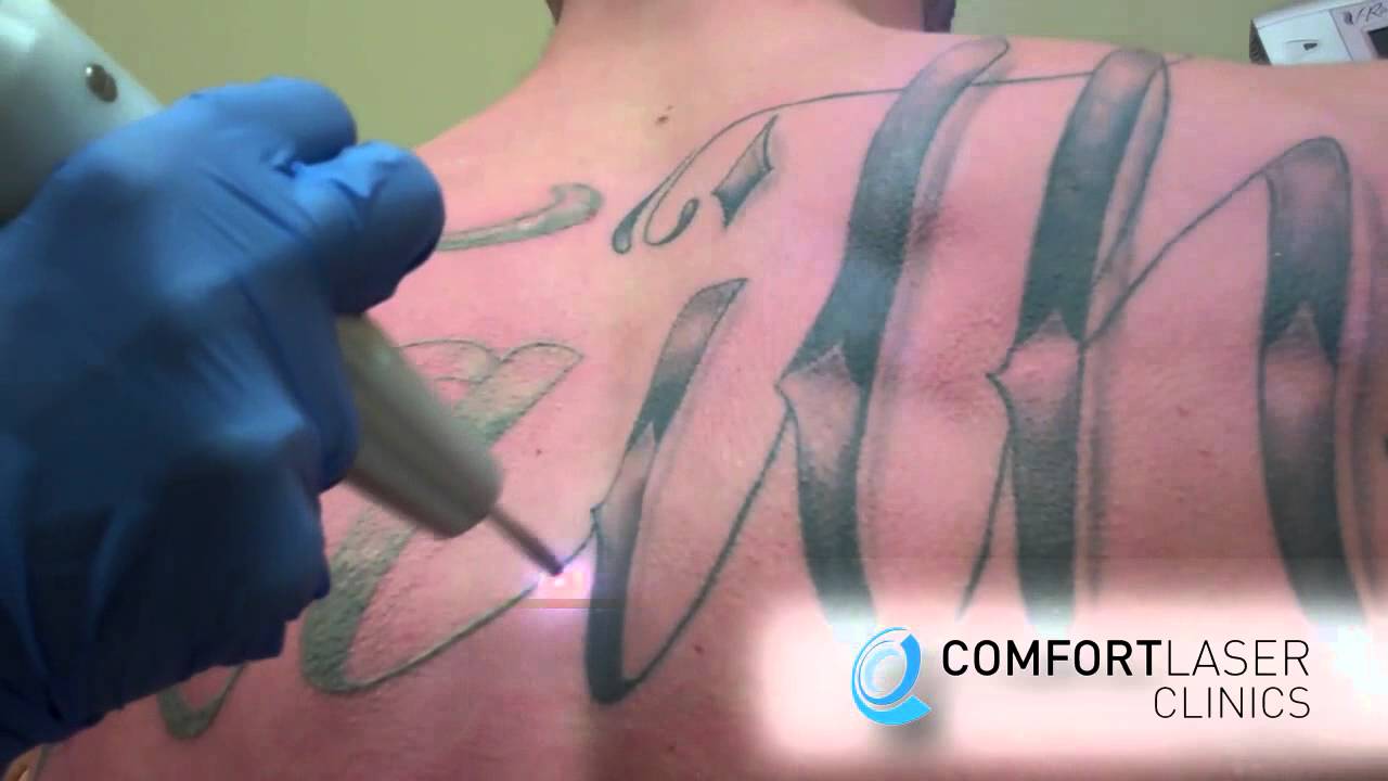 Laser Tattoo Removal on the Back - YouTube