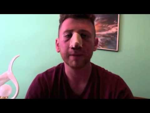 My Surgical Journey: Alex K.: Day 2, A Septorhinoplasty Diary of Top ...