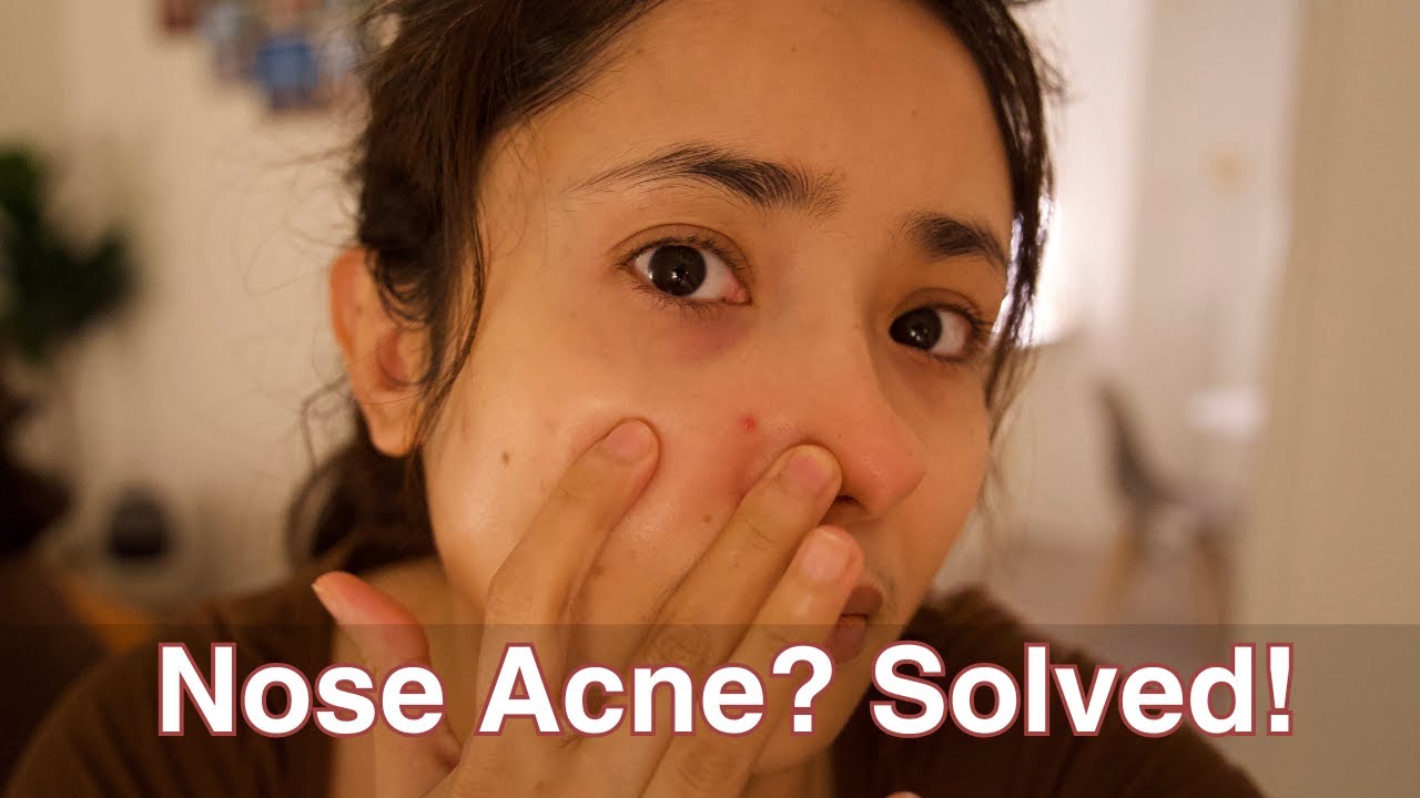 How To Get Rid of Nose Pimples in 3 Easy Ways - Skincare Specialist ...