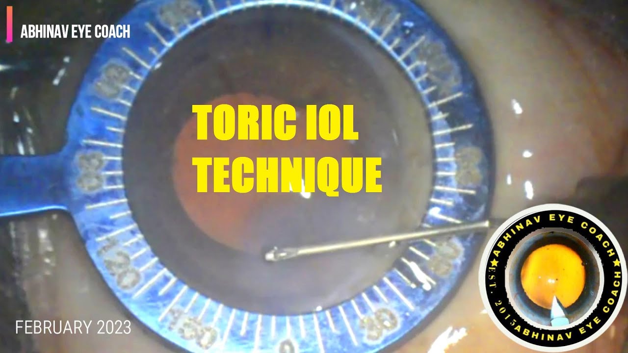 TORIC IOL TECHNIQUE - YouTube