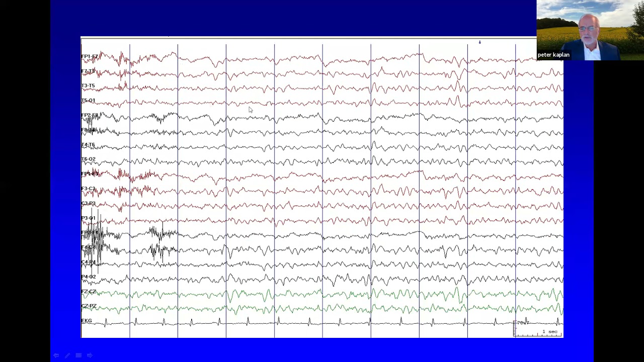 Grand Rounds. The EEG of Toxic-Metabolic Encephalopathy. Dr. Peter ...