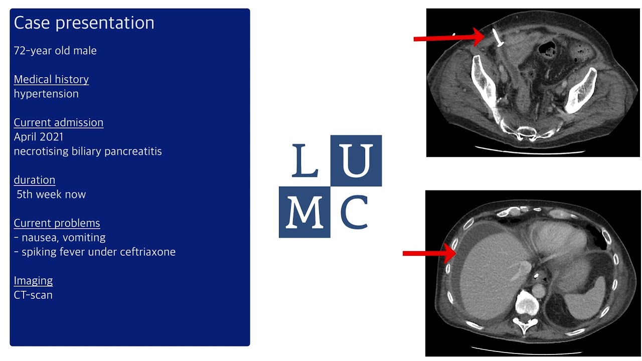 EUS guided pancreatic cyst drainage & endosocpic necrosectomy. Jeanin E ...