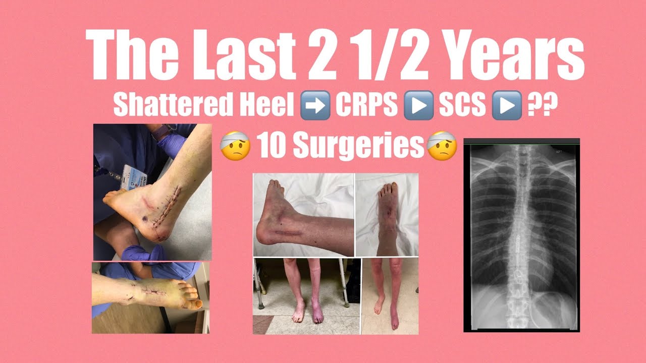 Shattered Heel — CRPS — Spinal Cord Stimulator (My Last 2.5 Years ...