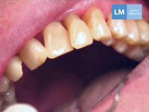 Clinical use of: Furcator and furcation Probe - YouTube