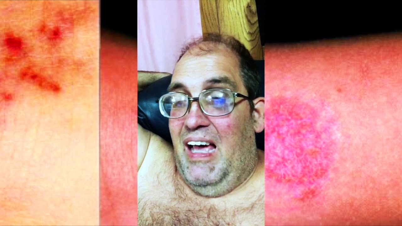 Skin Rashes - YouTube