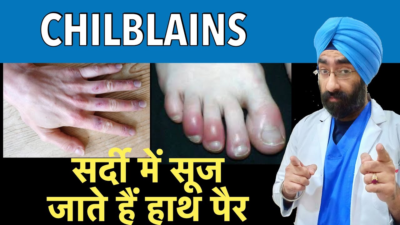 Chilblains : सर्दी में सूज जाते हैं हाथ पैर | Swollen hands and fingers ...
