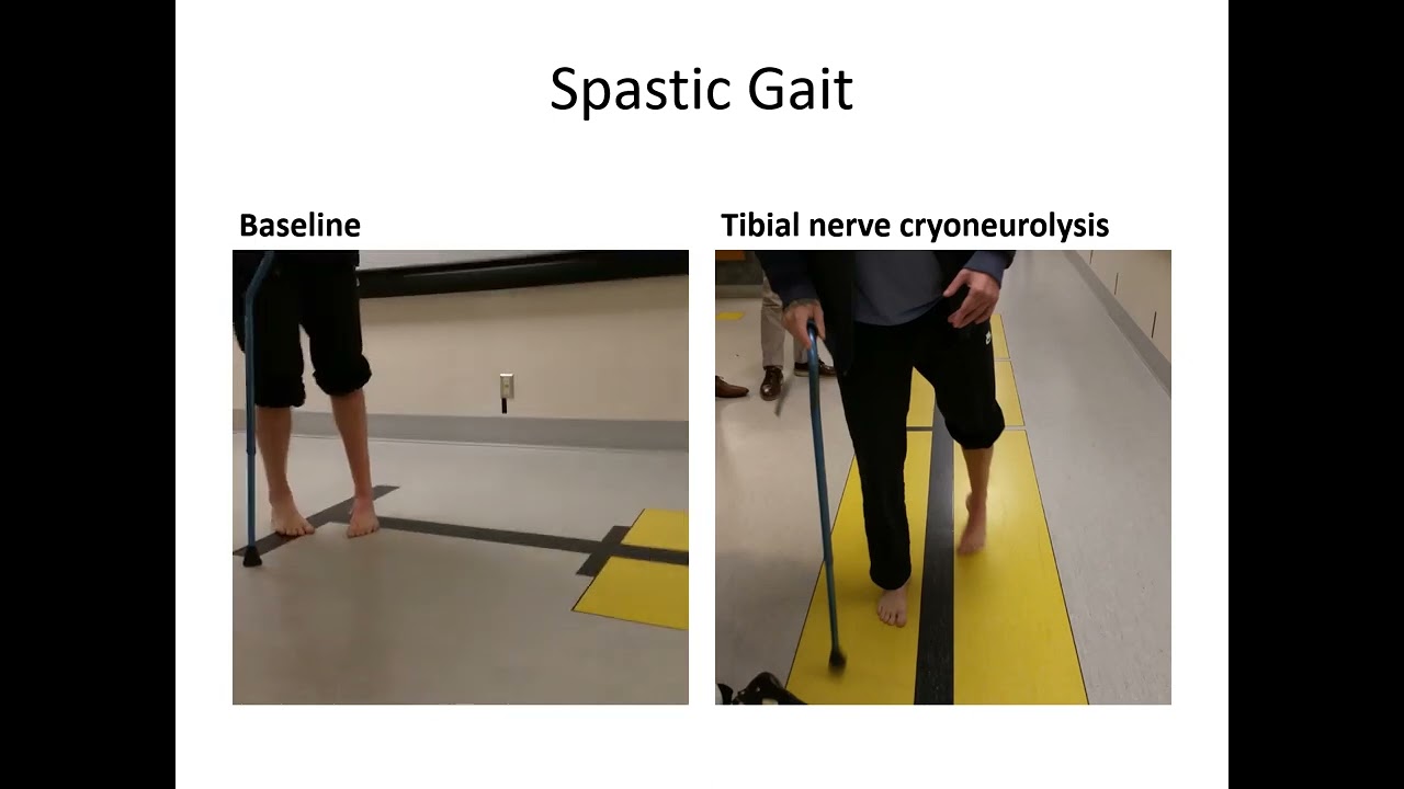 Multimodal treatment of spastic equinovarus foot - YouTube