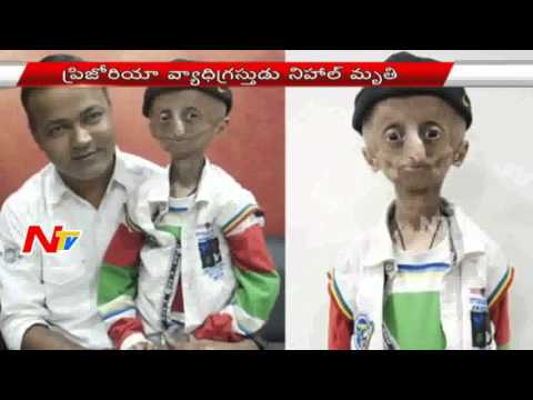 Progeria Patient Nihal Bitla Passes Away | NTV - YouTube