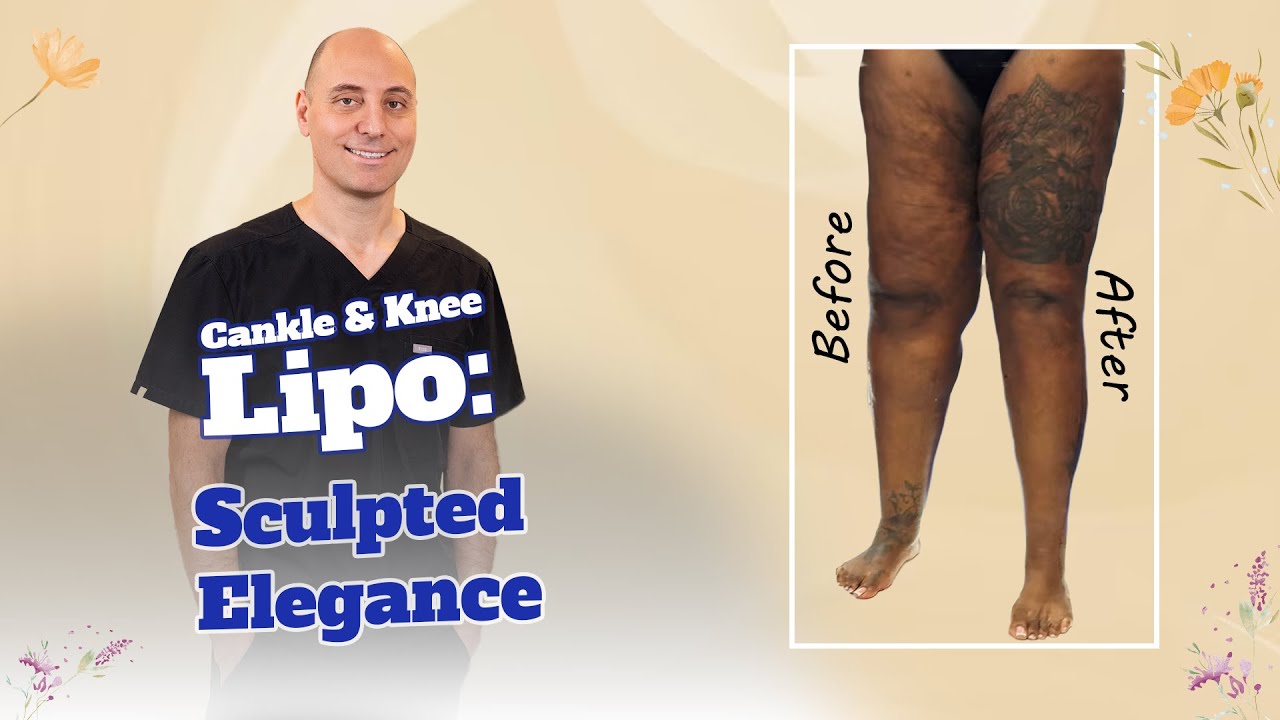 Unbelievable 360 Leg Liposuction in Tampa by Dr. Kardashian: Awake ...