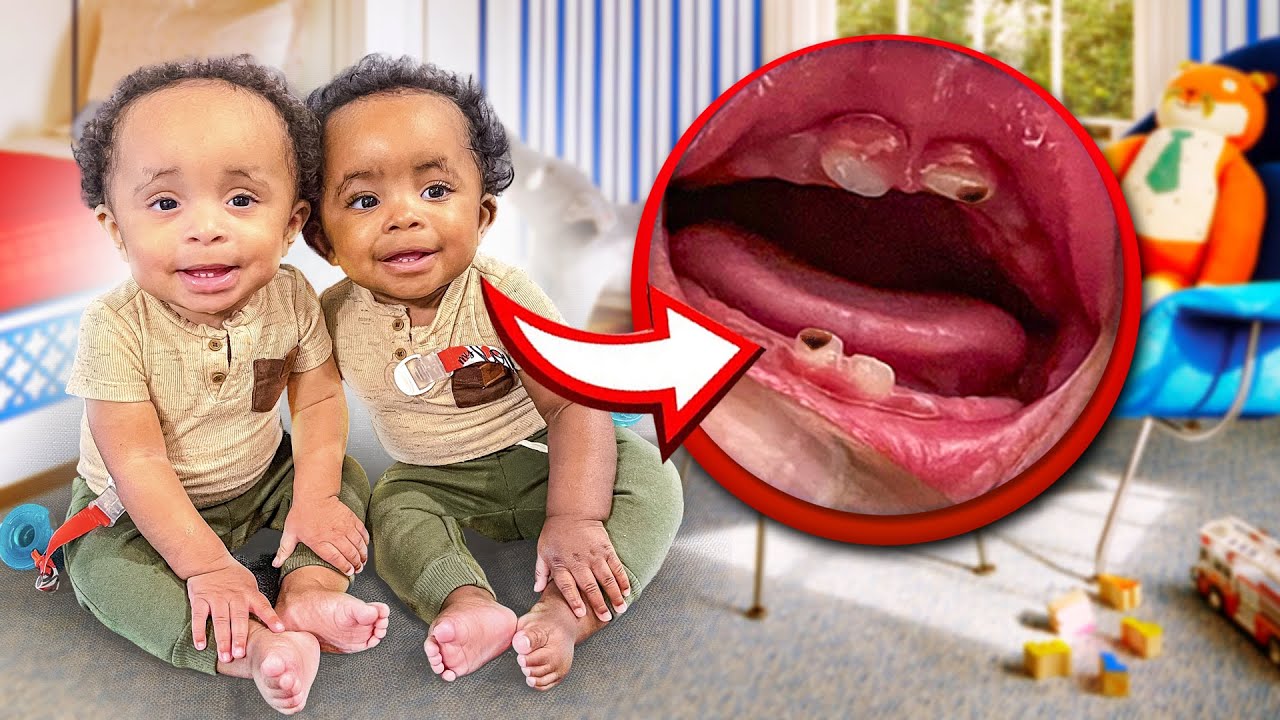 OUR **SECOND SET OF TWINS VERY FIRST TEETH CAME IN..BUT THIS HAPPENED 💔 ...