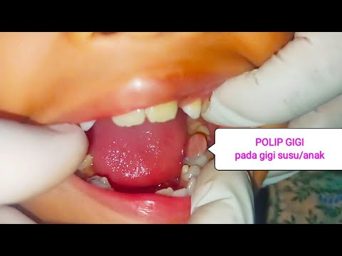 Polip Gigi Besar Pada Gigi Susu,Bagaimana Penanganannya - YouTube