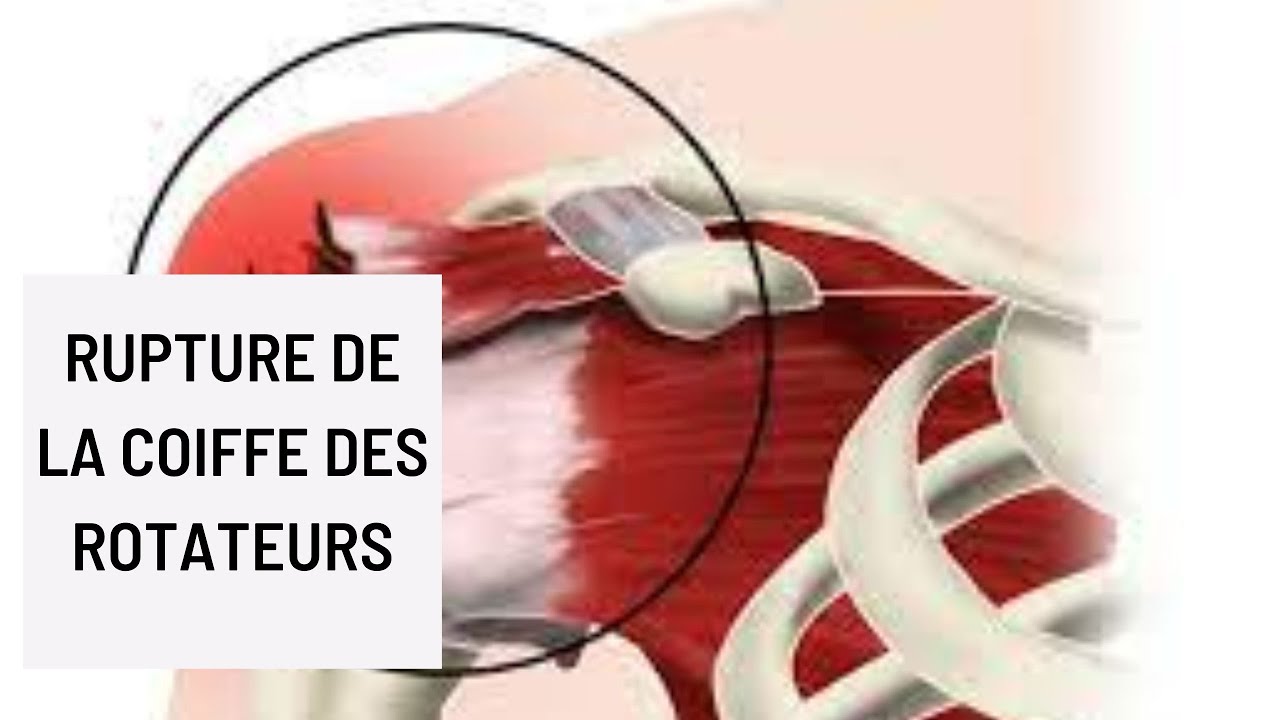 Rupture de la coiffe des rotateurs - YouTube