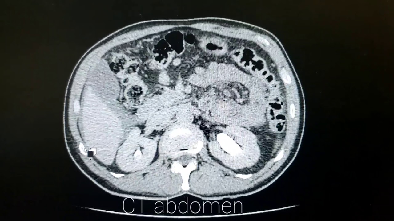 ct abdomen of urinary bladder rupture axial view - YouTube