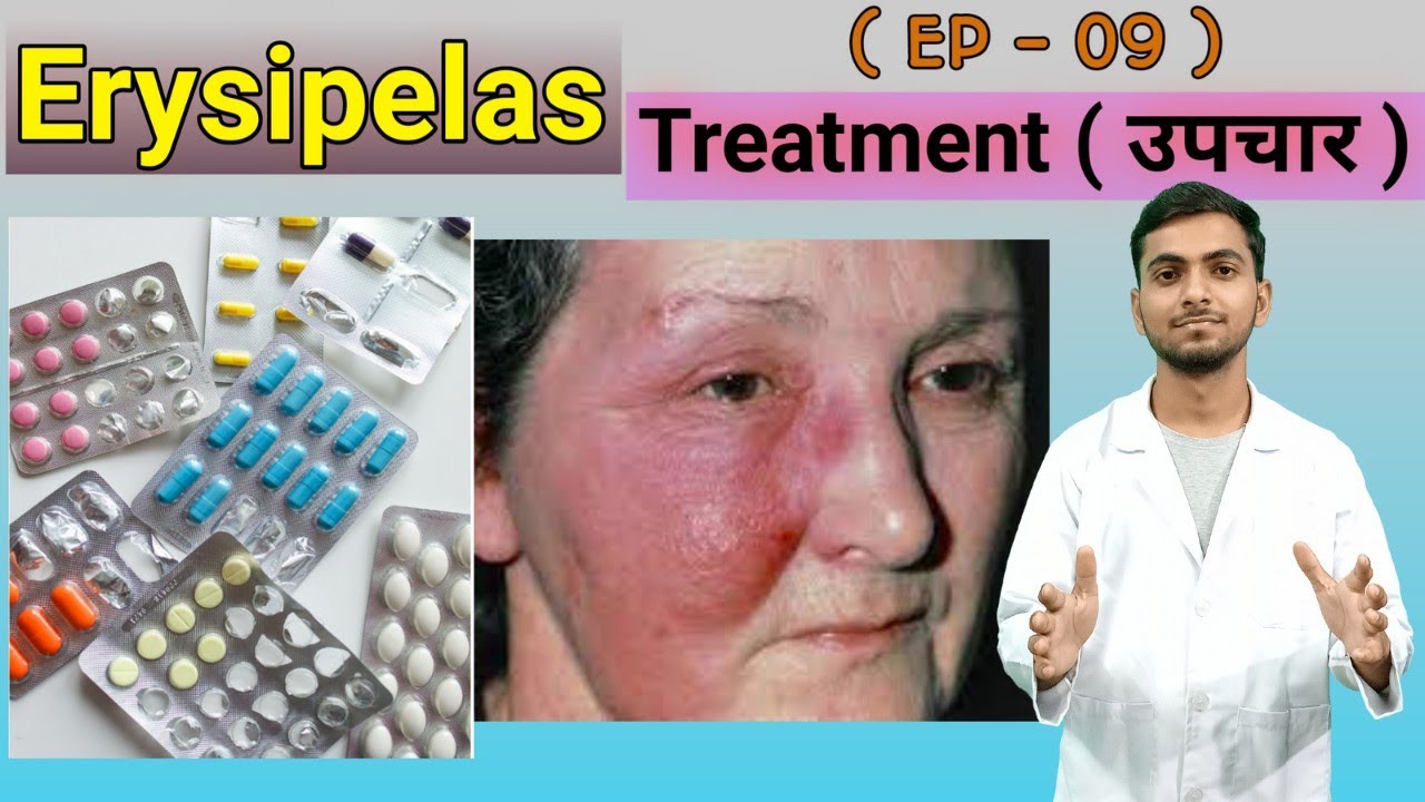 Erysipelas (विसर्प) Treatment | विसर्प इन्फेक्शन की दवाई | #antibiotics ...