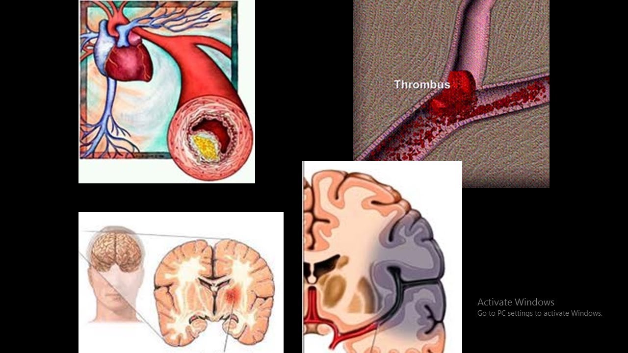 Diagnosis and Management of Acute Stroke - YouTube