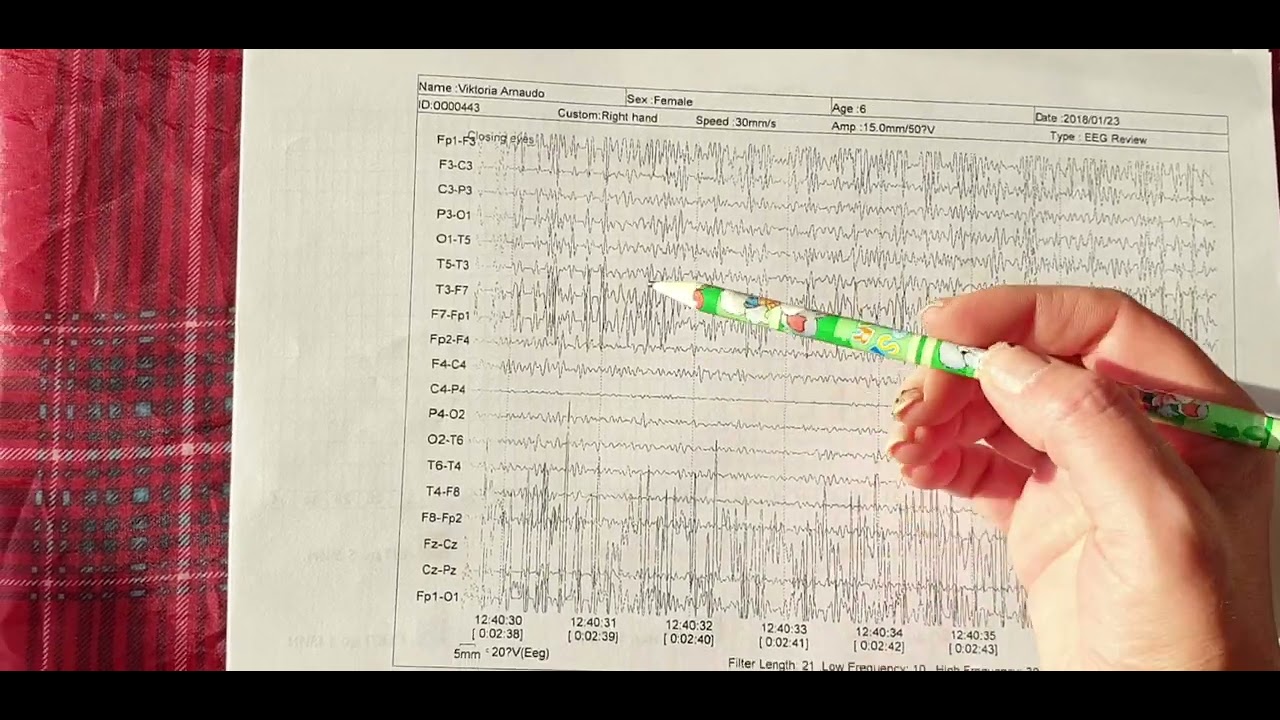 Reading a eeg of left side nonconvulsive status epilepticus. - YouTube