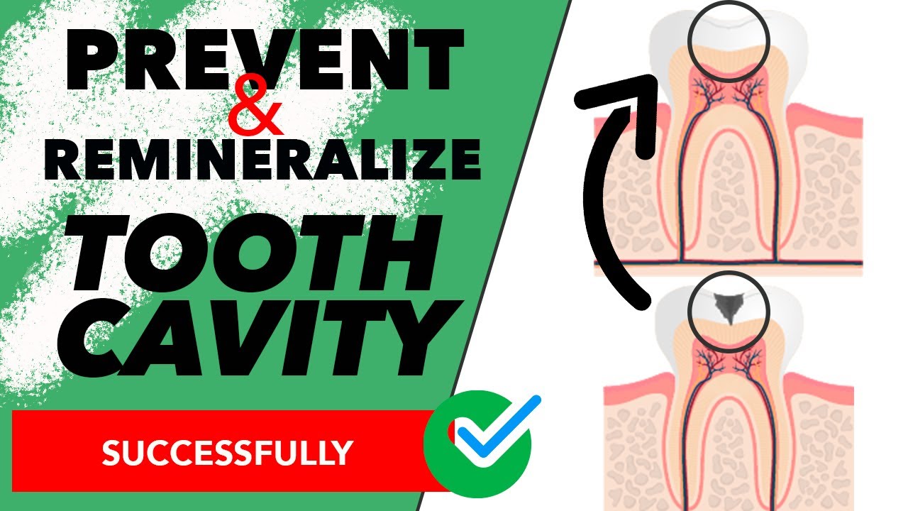 How To Prevent Teeth Cavities And Remineralize The Weakened Enamel ...