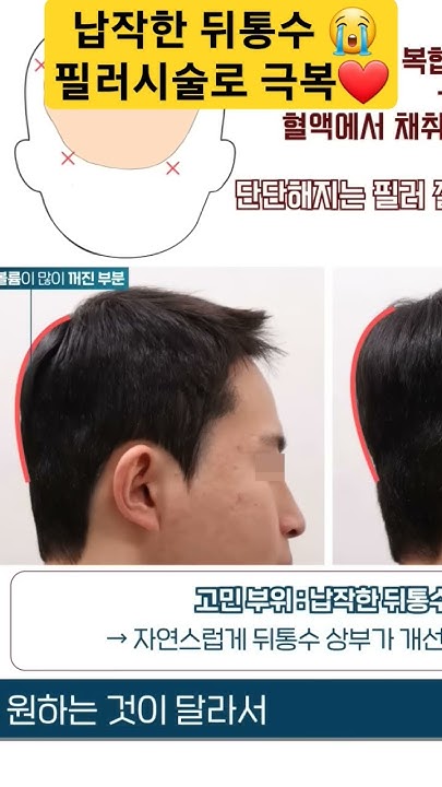 납작한 뒤통수 두상필러 자연스럽게 만들기 큐오필앤결 Youtube