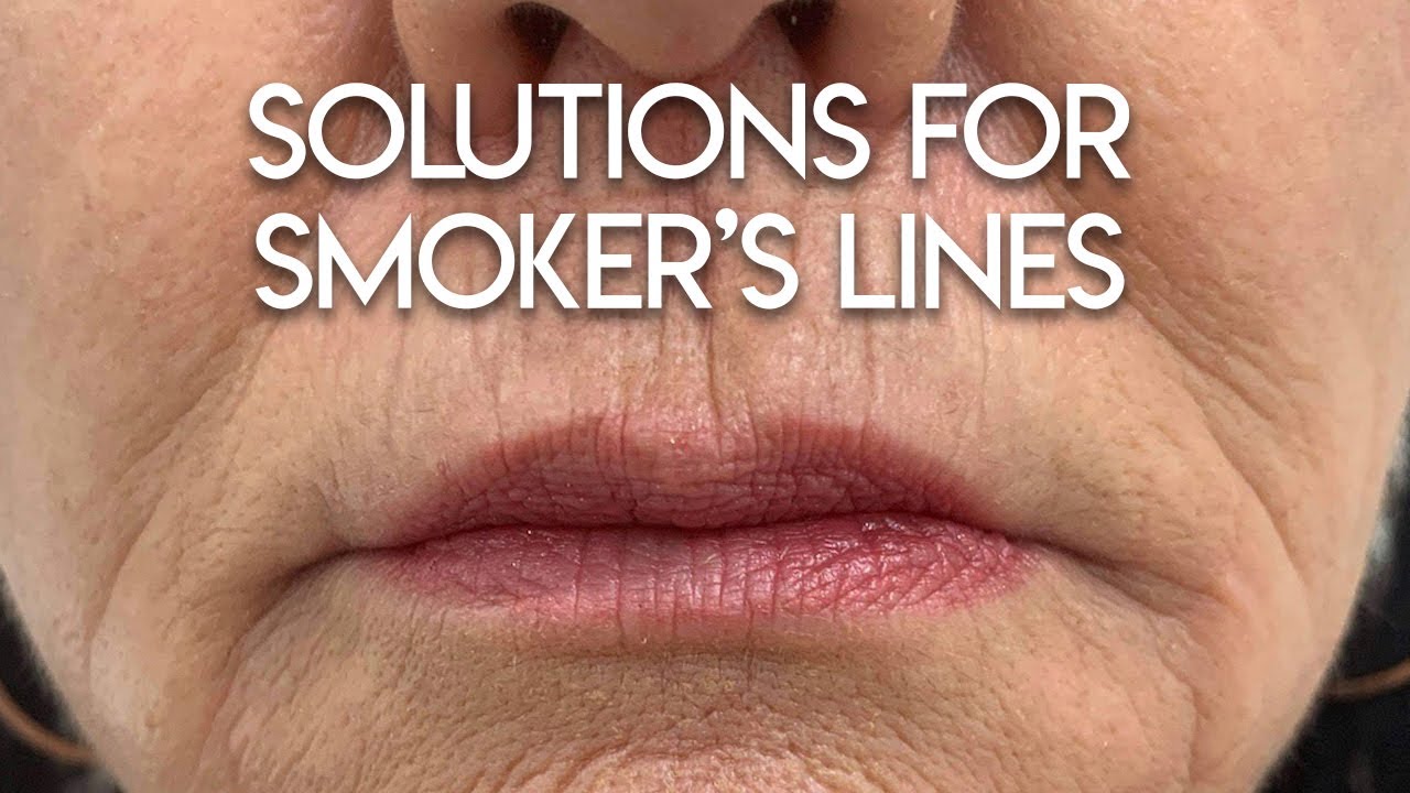 Solutions for Smoker's Lines - YouTube