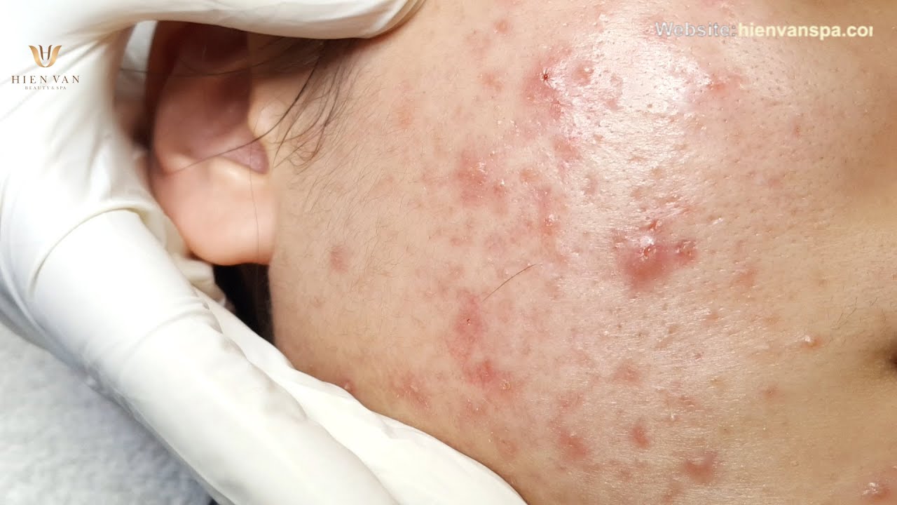 How to pop acne,blackheads,descripe acne treatment,skincare at Hien Van ...