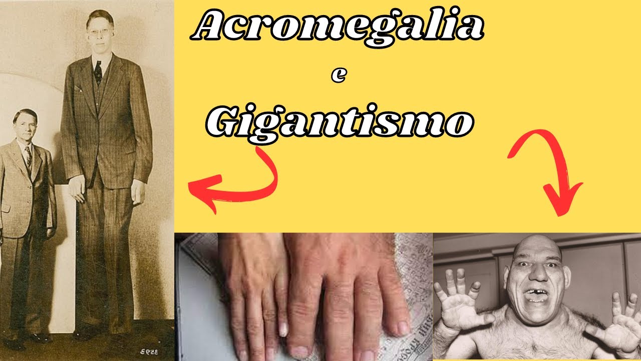 Acromegalia e Gigantismo: Fisiopatologia, Manifestações Clinicas ...