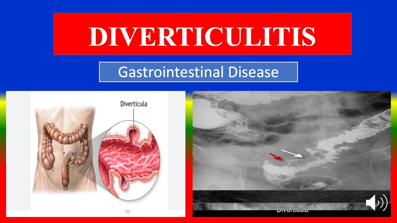 DIVERTICULITIS - Definition, types, cusses, pathophysiology, signs ...