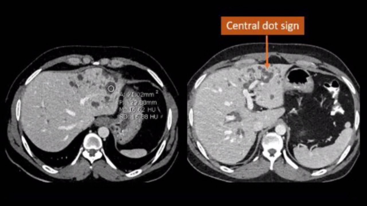 Caroli disease - YouTube