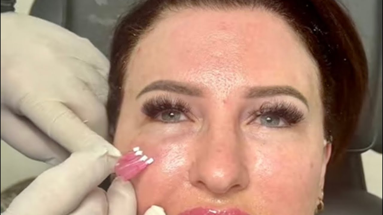 Pdo thread tear trough | Newcastle Cosmetic Doctor | Skin tightening ...