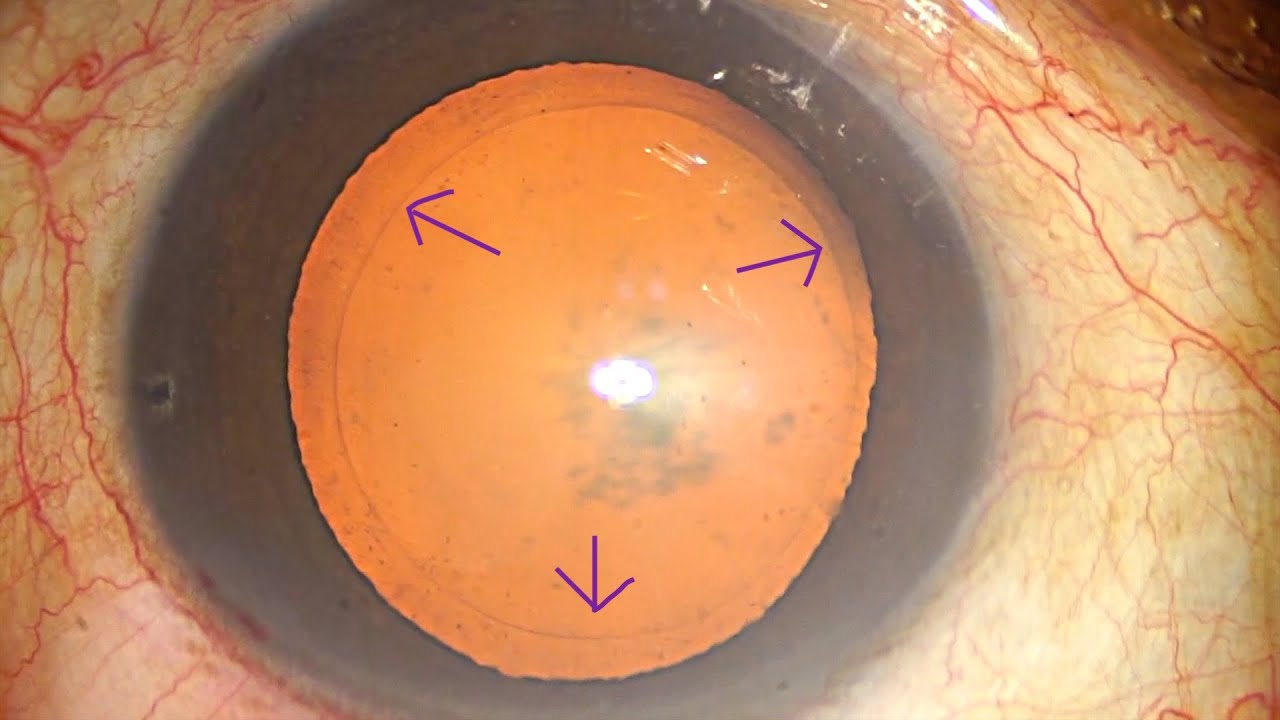 Nature's own Rhexis Reference Marker - Dr Ramakrishna Tadanki - YouTube