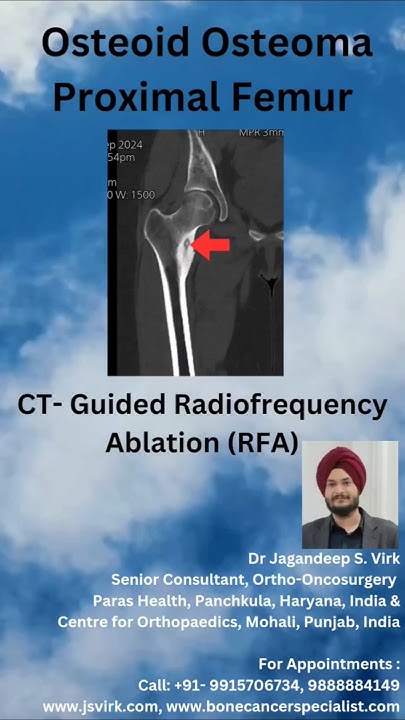 CT-Guided Radiofrequency Ablation (RFA) for Osteoid Osteoma near Hip Joint by Dr Jagandeep S ...