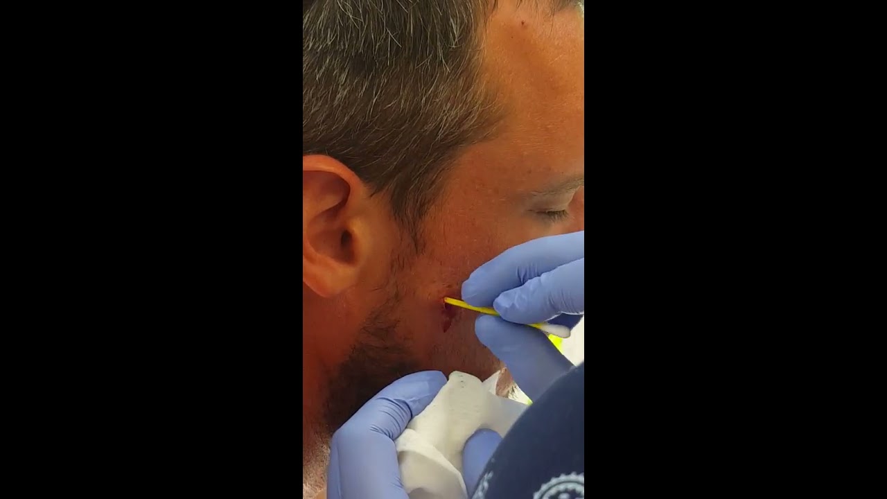 Cyst under pressure! Digging for the sac! Pimple poppers! - YouTube