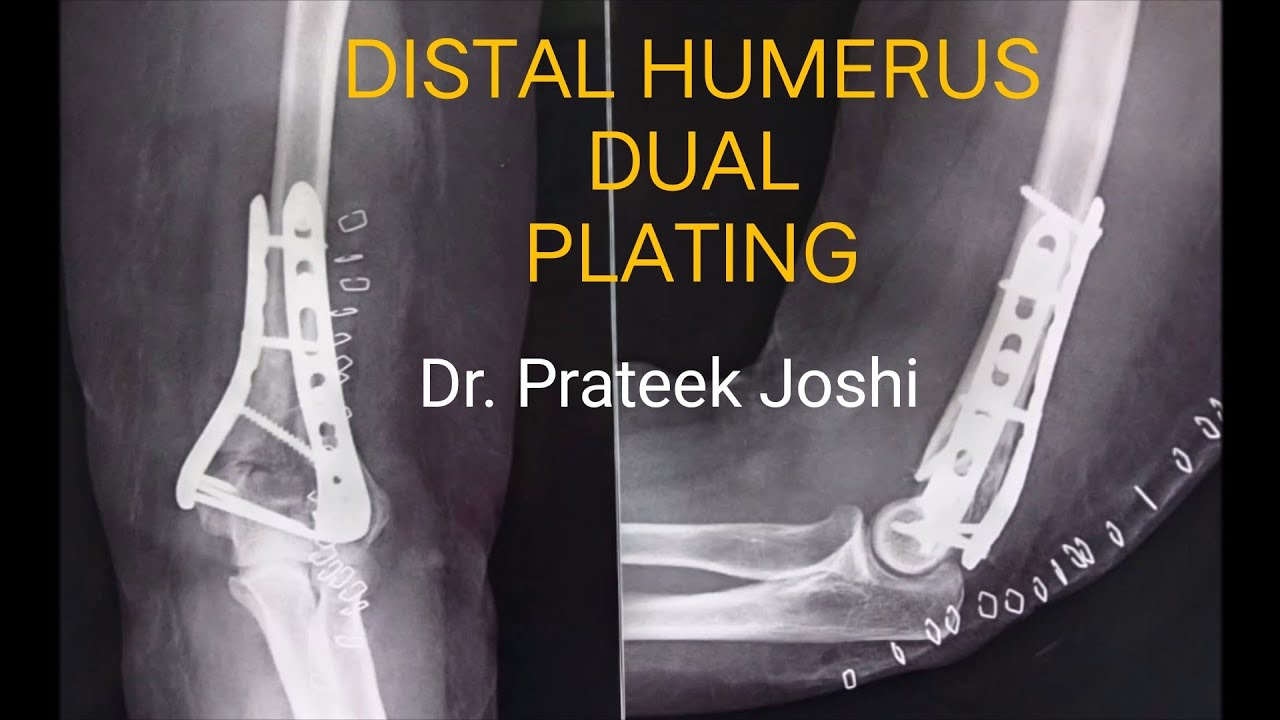 Distal Humerus Dual Plating | Elbow Fracture Surgery | Dr. Prateek ...